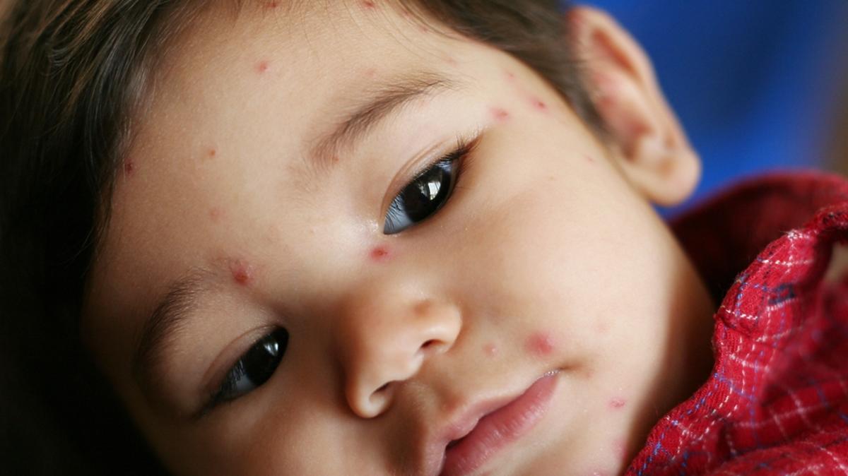 Choroby zakaźne - ospa wietrzna